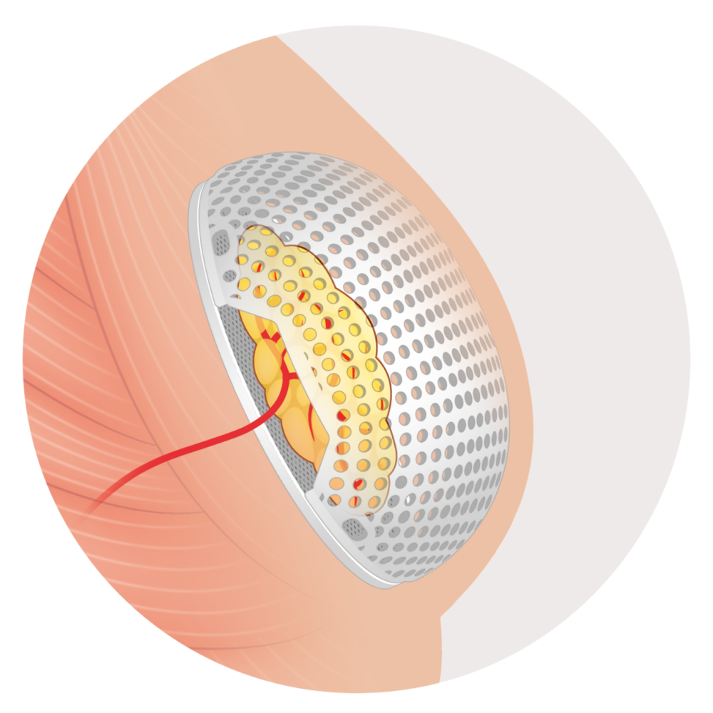 MATTISSE - Prothèse mammaire - Lattice Medical